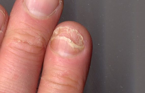 Understanding and Treating Common Fingernail Abnormalities | Polish and ...