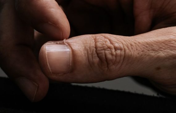 How to Heal and Soothe an Infected Hangnail | Polish and Pearls