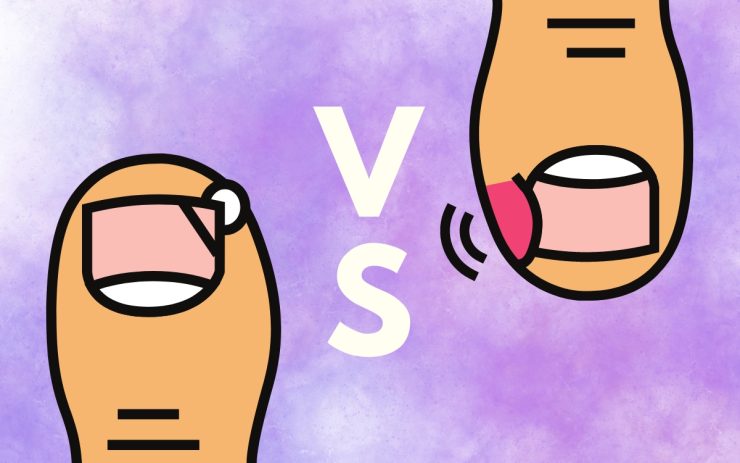 Ingrown Nails vs. Paronychia - How to Tell Them Apart | Polish and Pearls